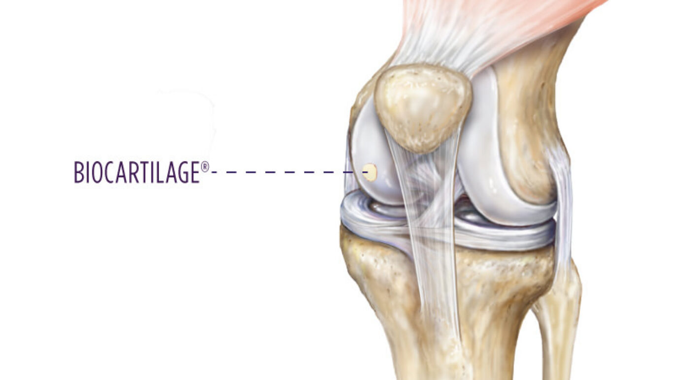 Dr. Skendzel Explains Treatments For Knee Cartilage Injuries | Summit ...