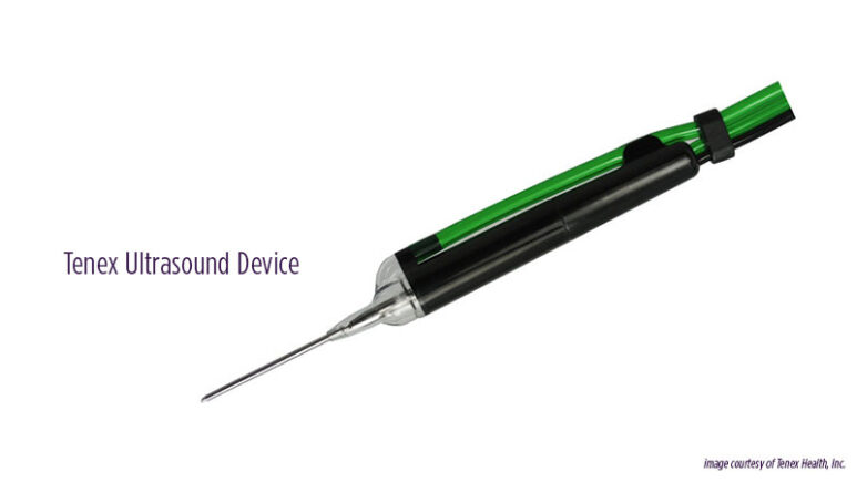 Ask Dr. Scofield: How Does Tenex Technology Work? | Summit Orthopedics