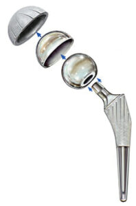 Total Hip Replacement | Summit Orthopedics