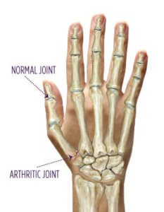 Arthritis of the Hands | Summit Orthopedics