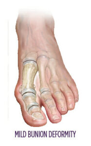 Bunions | Summit Orthopedics